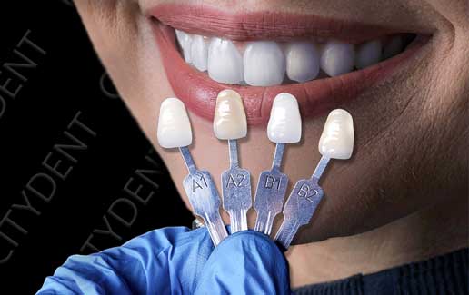Zirconia Crown Color Guide | Natural & Hollywood Shades