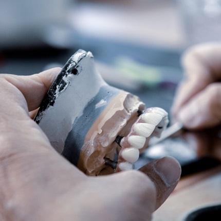 Implant Abutment | What Is a Dental Abutment & Crown Connector?