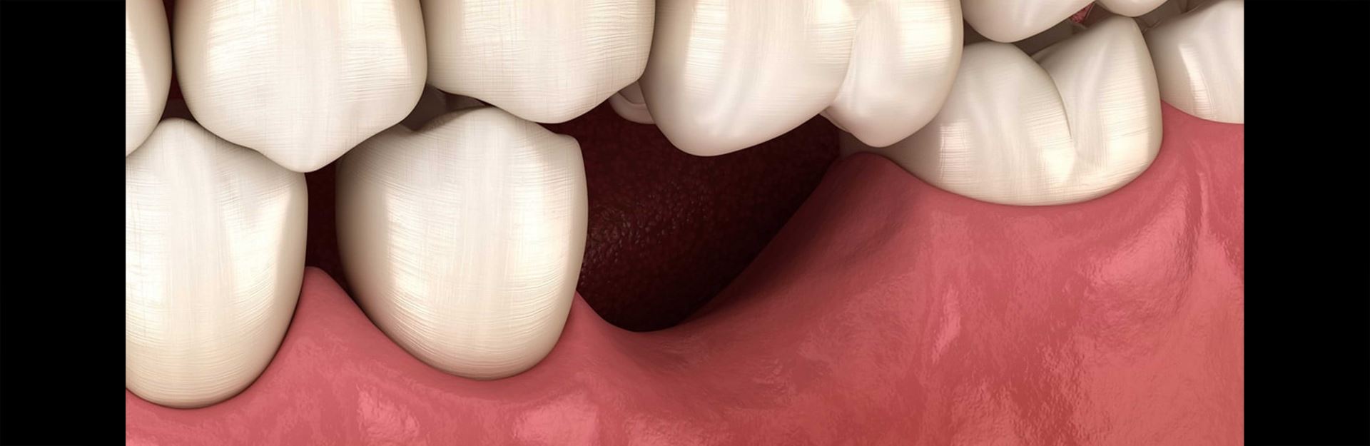 Loose Teeth in Adults – Causes & Treatment in Istanbul