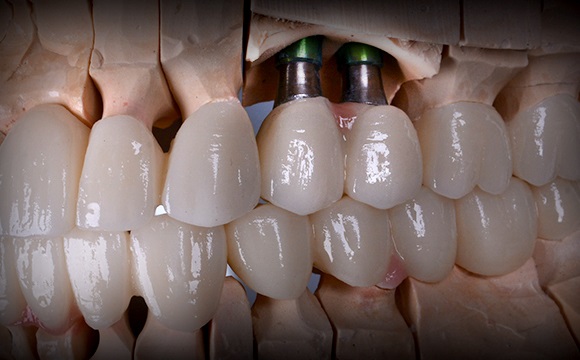 Aesthetic Implant Treatment | Citydent